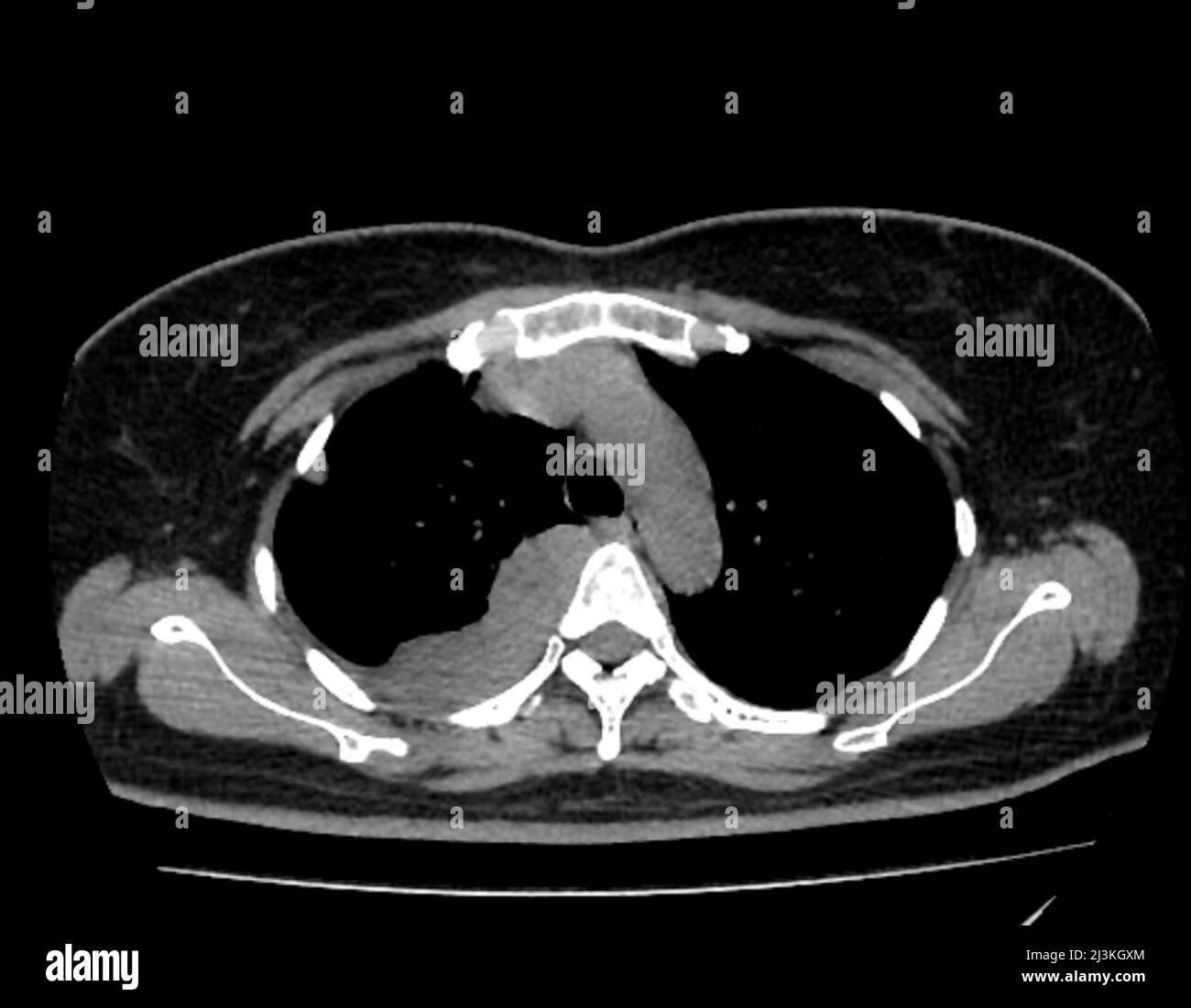 Pleural mass, chest CT scan Stock Photo - Alamy