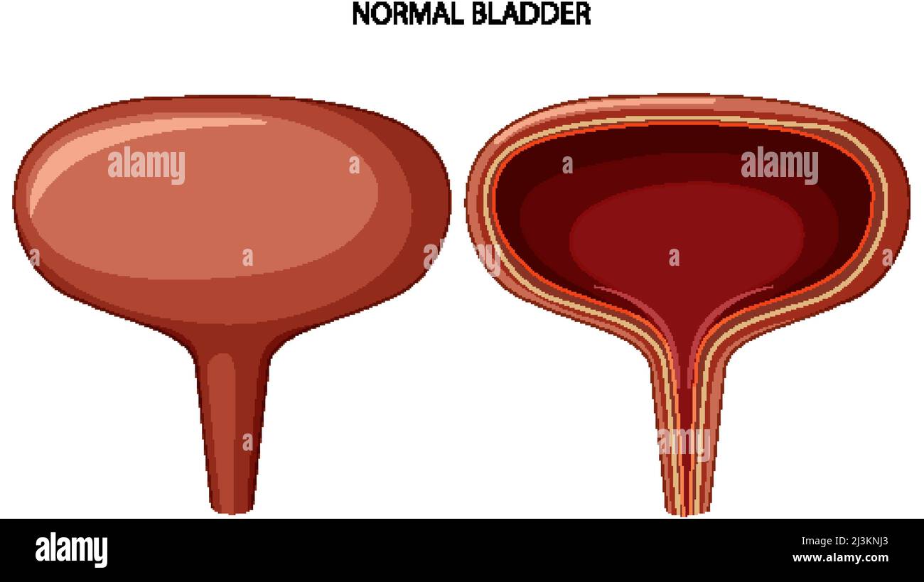 Stage of bladder cancer illustration Stock Vector Image & Art - Alamy
