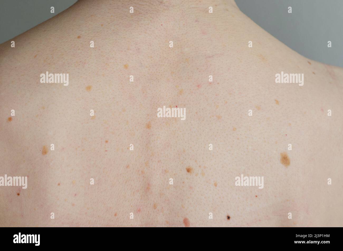 Moles on white female hi-res stock photography and images - Alamy