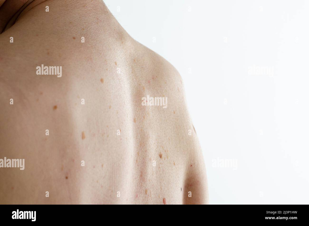 Female mole hi-res stock photography and images - Alamy