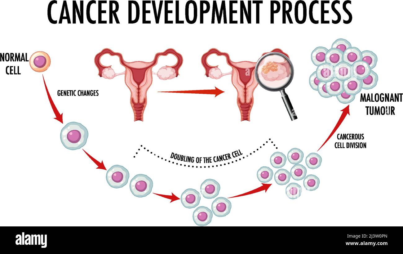 Diagram showing normal and cancer cells in human illustration Stock ...