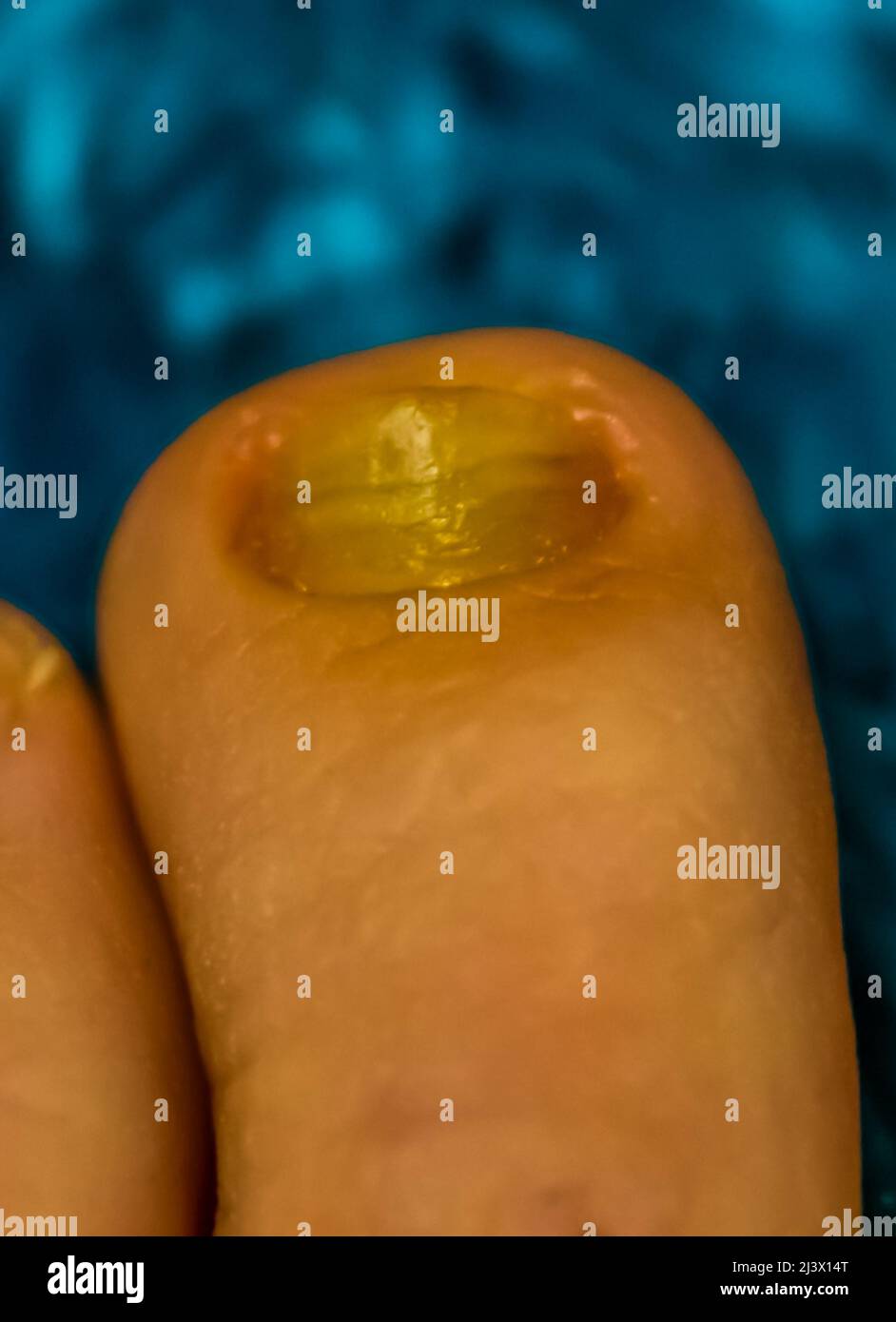 macro close up of a fungus infected toe nail, common infections and ...