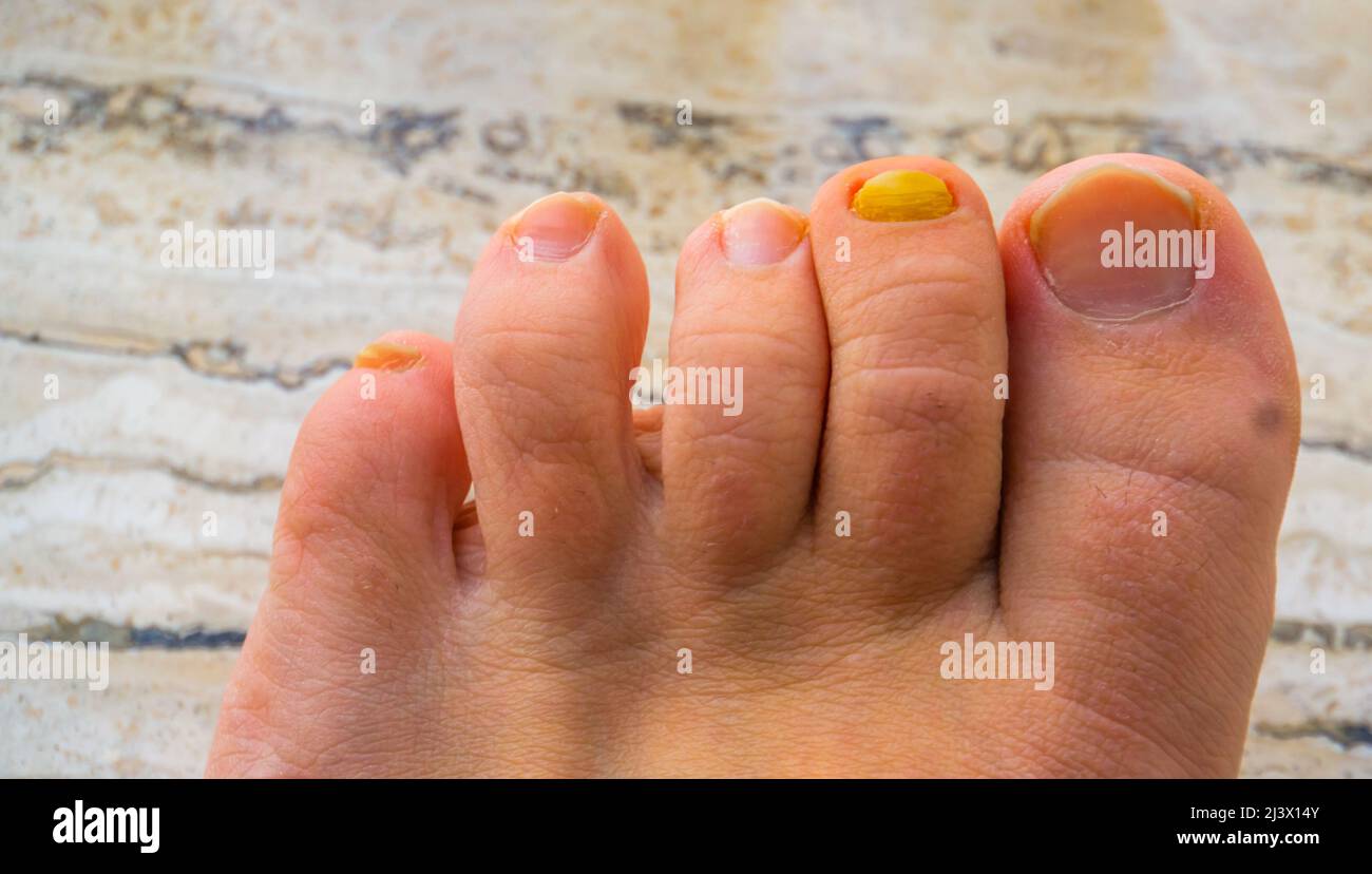 toes in close up with a fungus infected nail, Common infection and ...