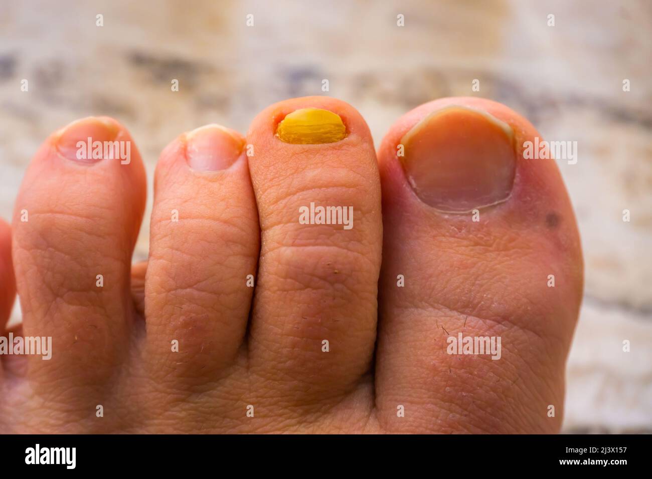 close up of toe nails with one fungus infected nail, Common disease and ...