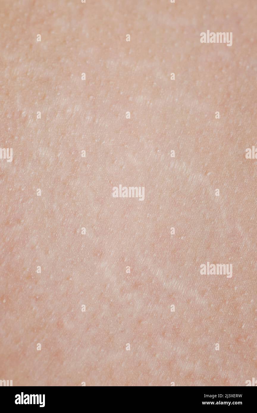 Stretch marks on human skin macro close up view Stock Photo - Alamy