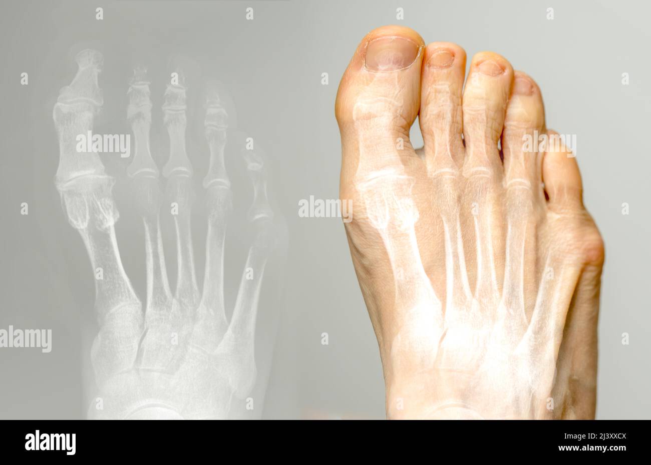 X-ray and the same foot. Hallux varus condition Stock Photo - Alamy