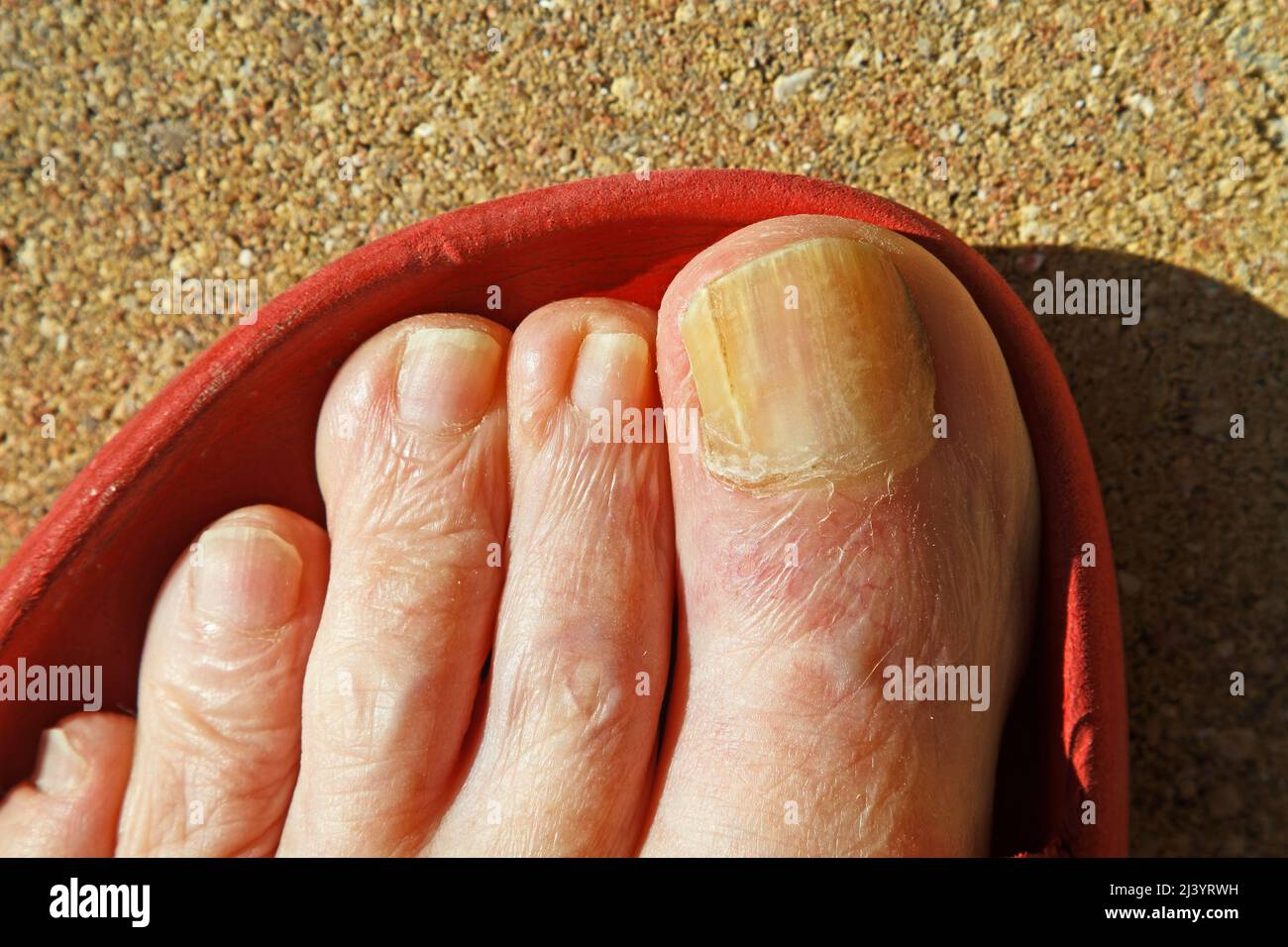 toenail fungus, foot, great toe, close-up, medical condition, disease ...