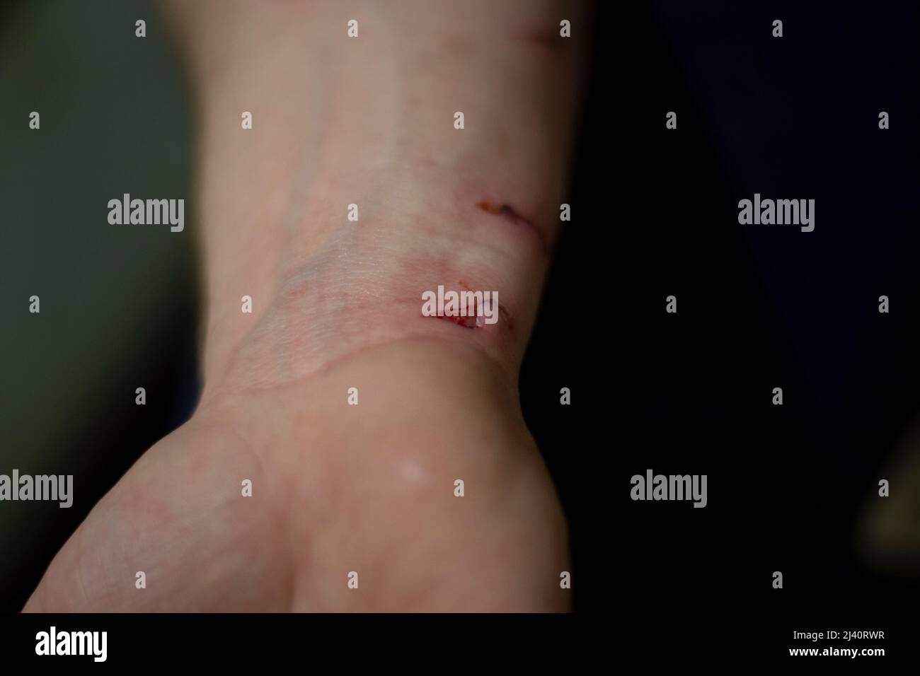 A wound on the arm. Blood from the cut. Cotton wool to remove blood on ...