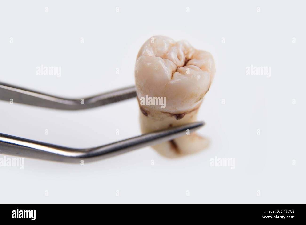Pulled out adult tooth in the tweezer on a white Stock Photo - Alamy