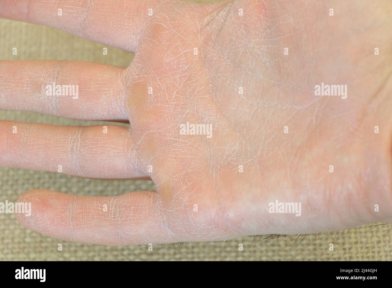 A man's hand dehydrated with cracks due to the cold wind of early ...