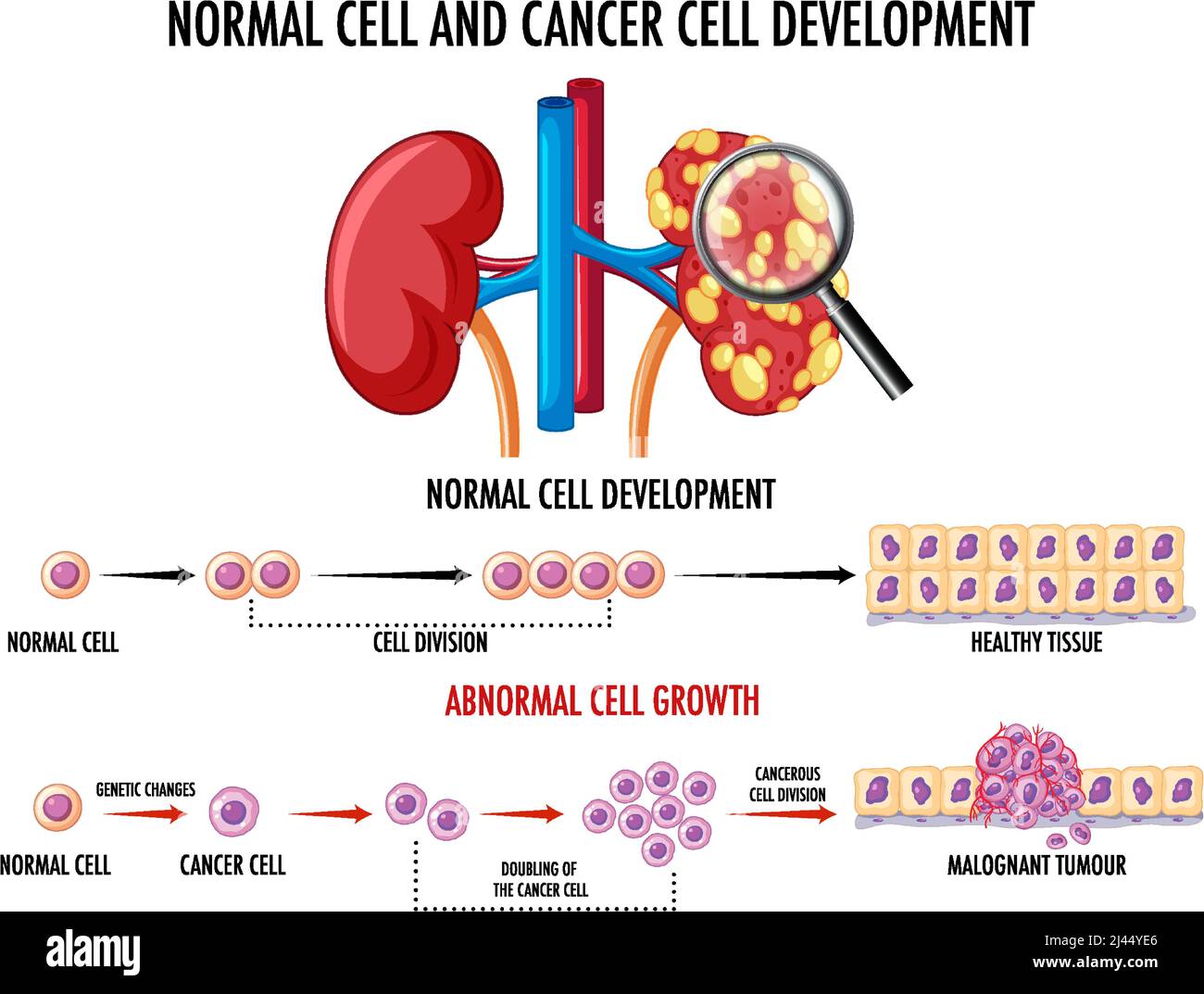Diagram showing cancer development process illustration Stock Vector ...