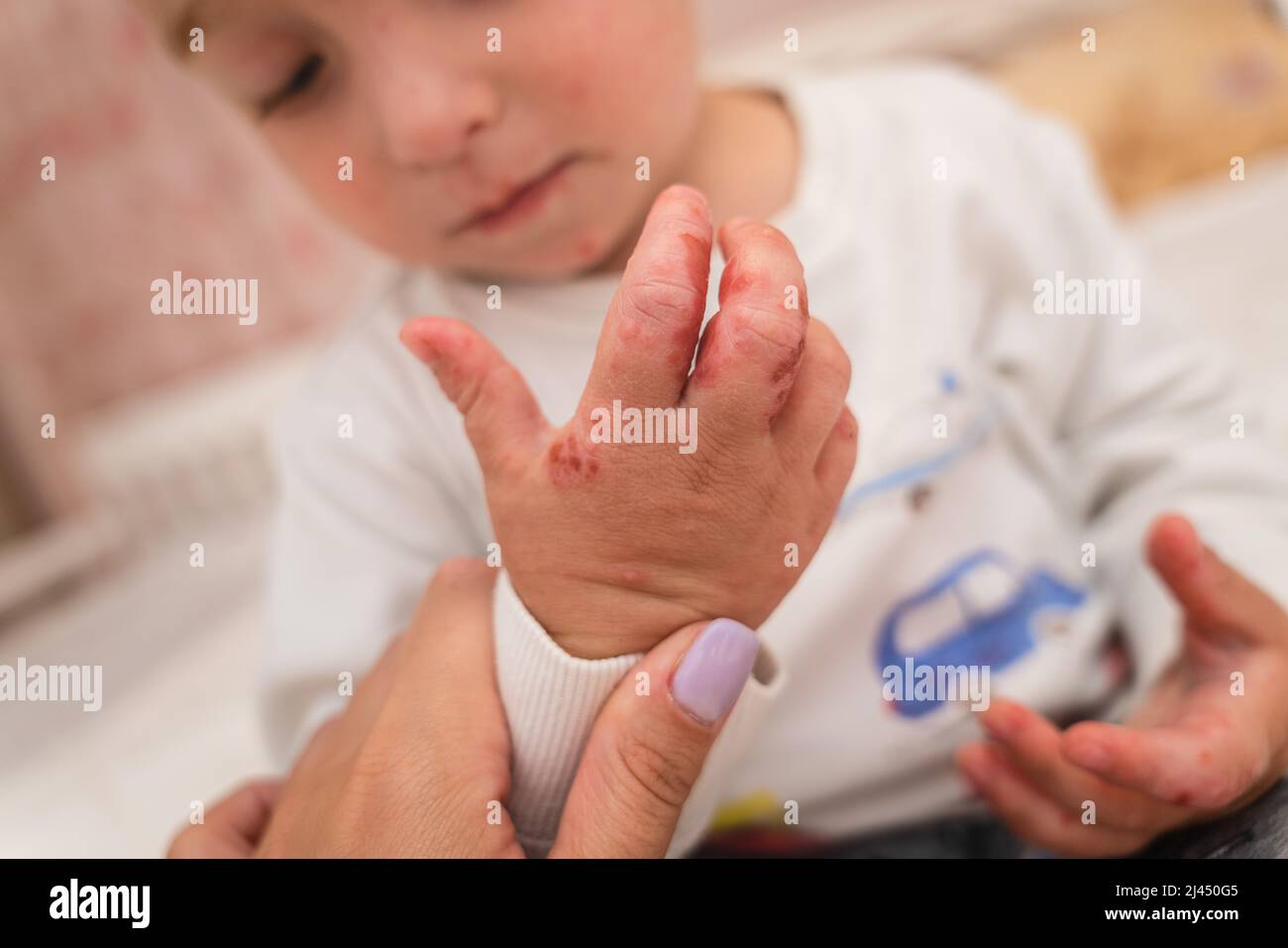 Close up enterovirus on baby body Stock Photo - Alamy