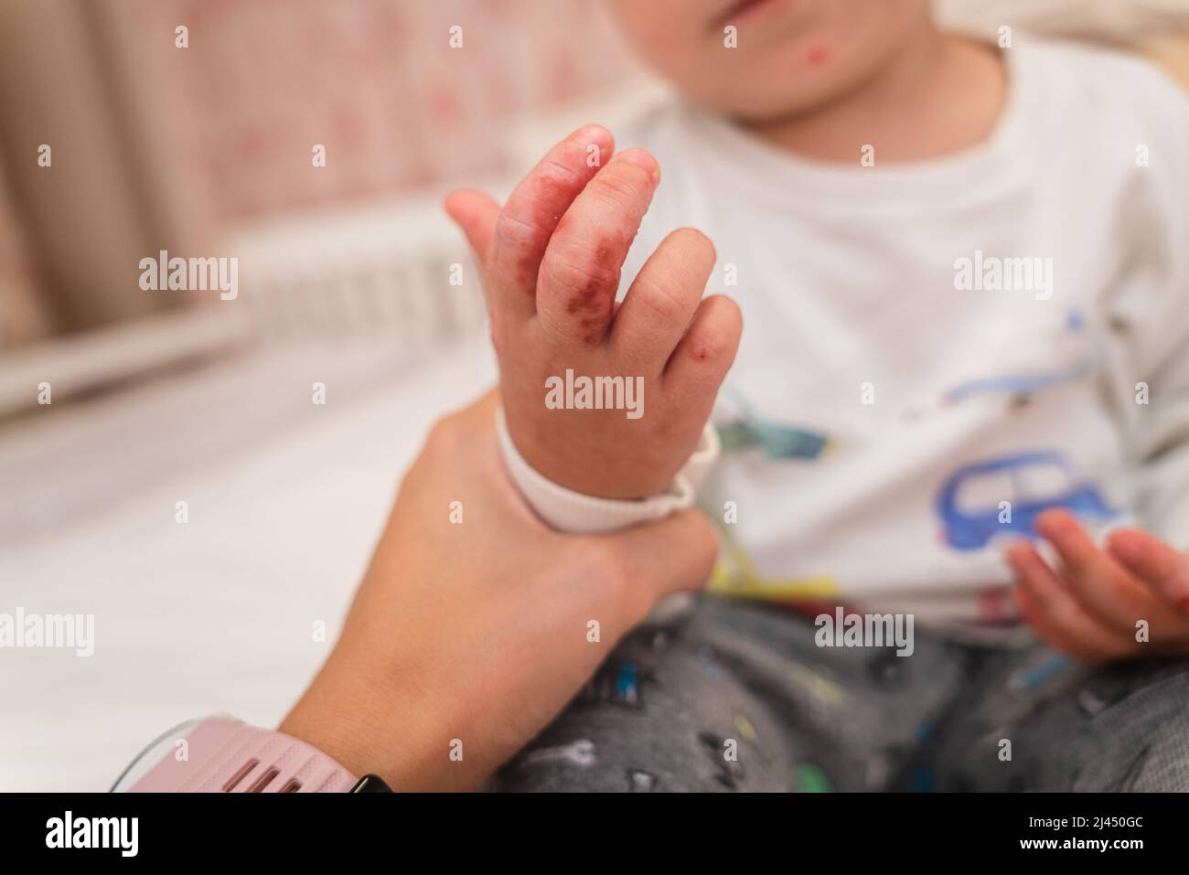 Close up enterovirus on baby body Stock Photo - Alamy