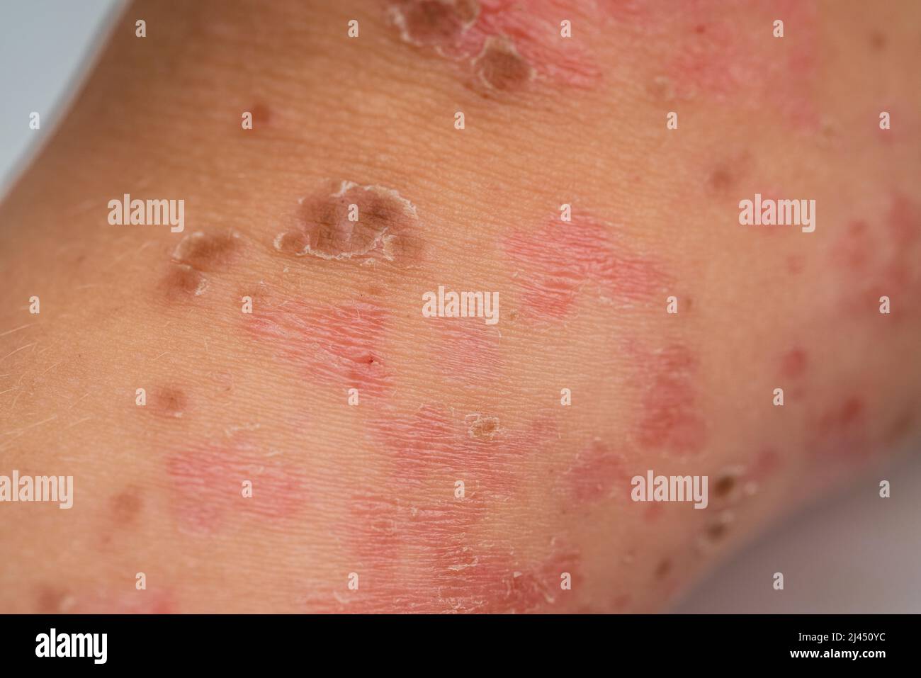 Close up enterovirus on baby body Stock Photo - Alamy