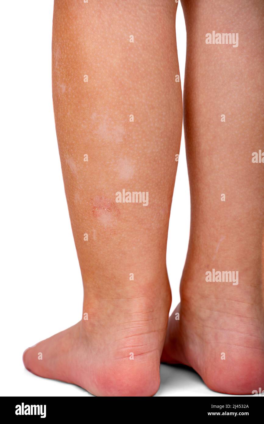 traces of atopic dermatitis on children's feet Stock Photo - Alamy