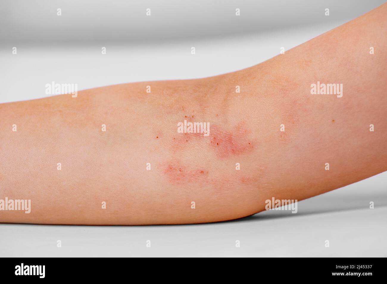 atopic dermatitis on the child's arm Stock Photo - Alamy