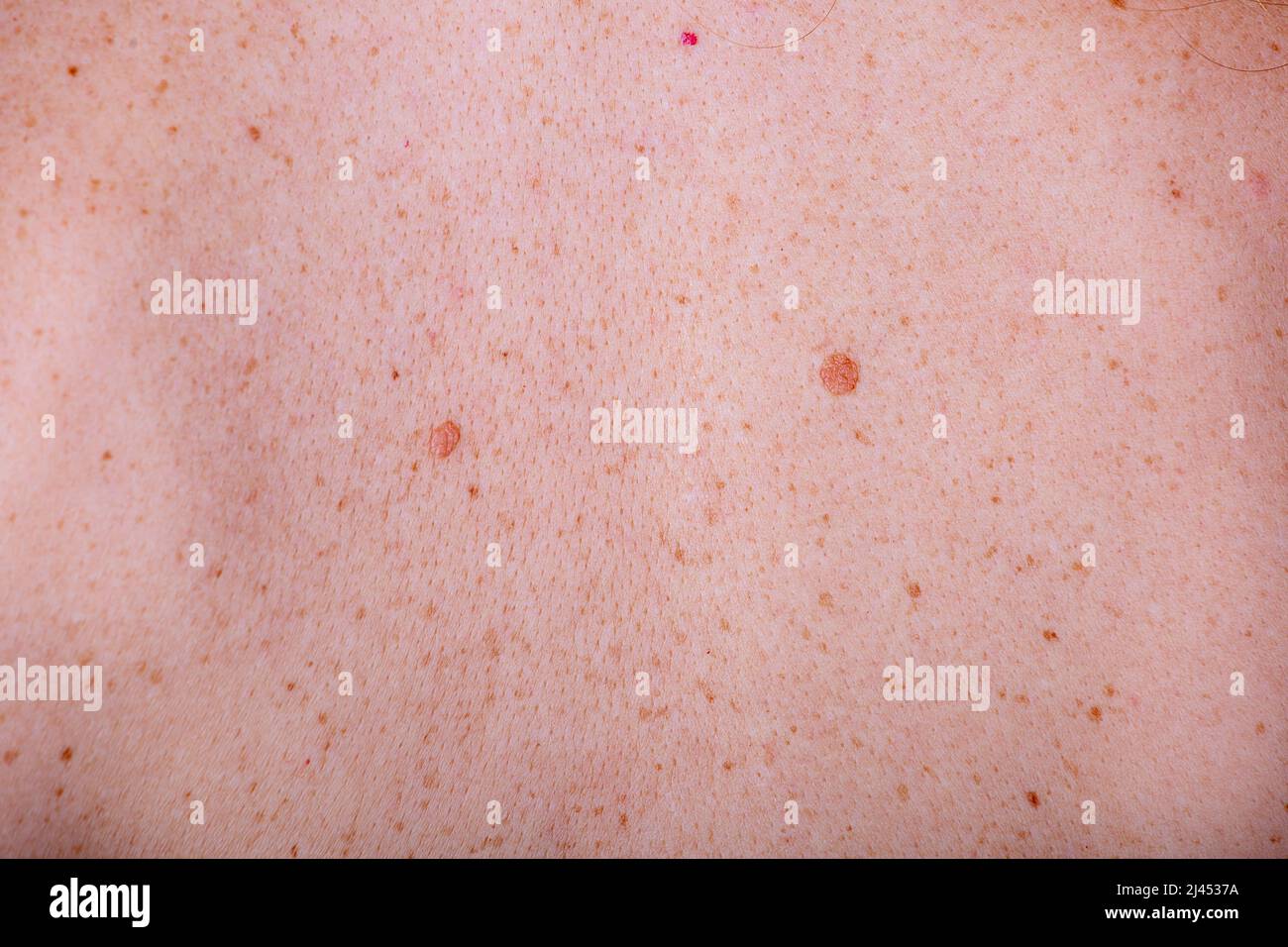 Moles on the skin Stock Photo - Alamy