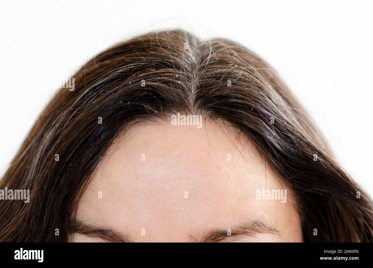 Dandruff in dark hair Stock Photo - Alamy