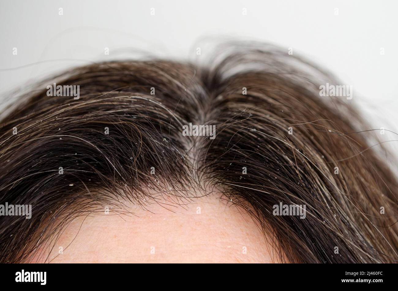 Dandruff in dark hair Stock Photo - Alamy
