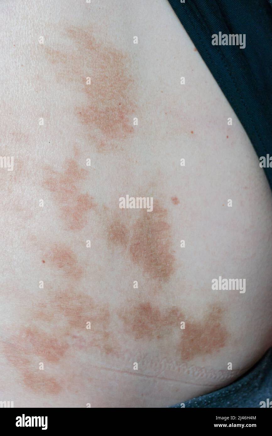 Red-brown spots on the skin of a woman near the abdomen Stock Photo - Alamy