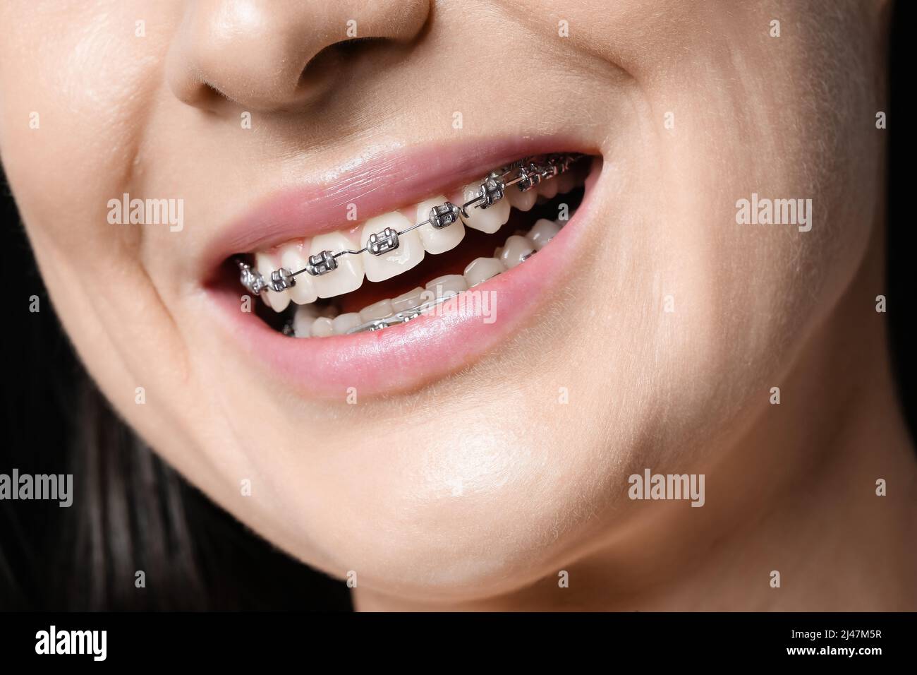 Overbite smile smiling hi-res stock photography and images - Alamy