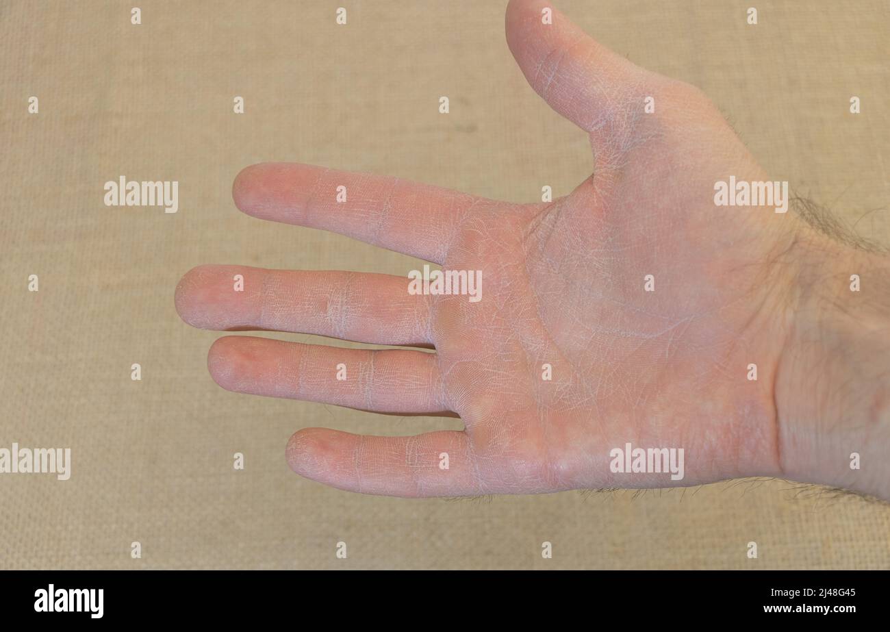 A man's hand dehydrated with cracks due to the cold wind of early ...