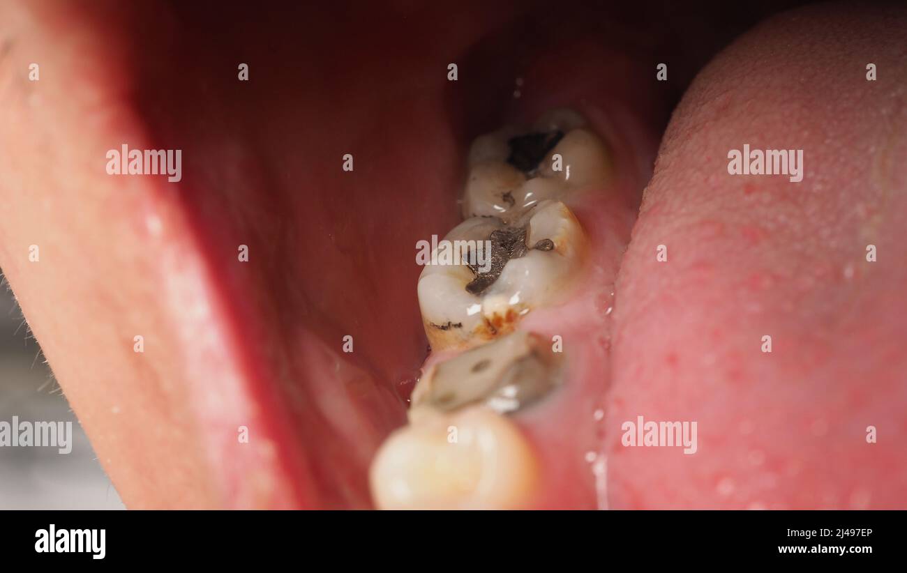 Decayed tooth root canal treatment. Tooth or teeth decay of lower molar ...