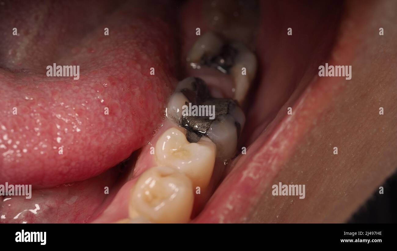 Decayed tooth root canal treatment. Tooth or teeth decay of lower molar ...