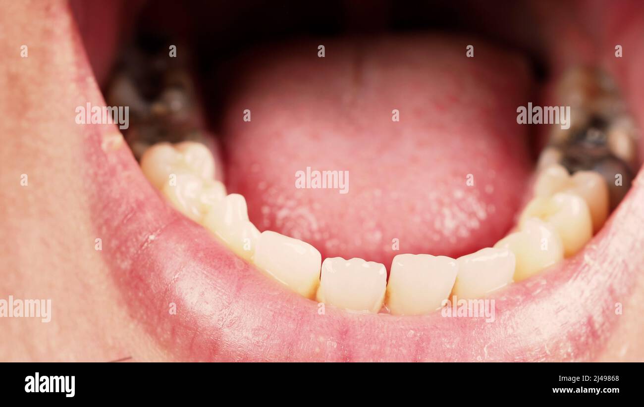 Decayed tooth root canal treatment. Tooth or teeth decay of lower molar ...