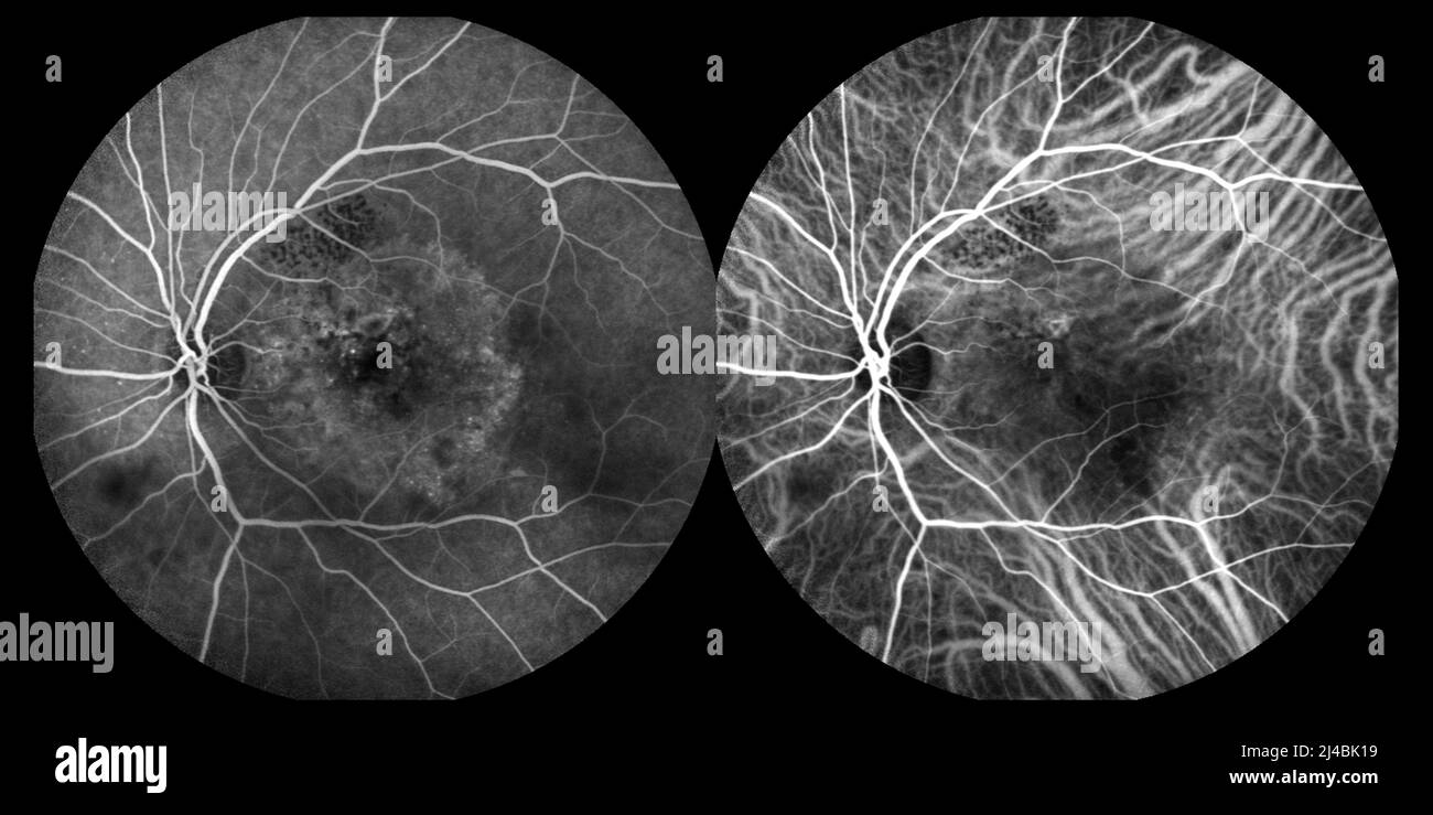 Macular degeneration, angiogram Stock Photo - Alamy