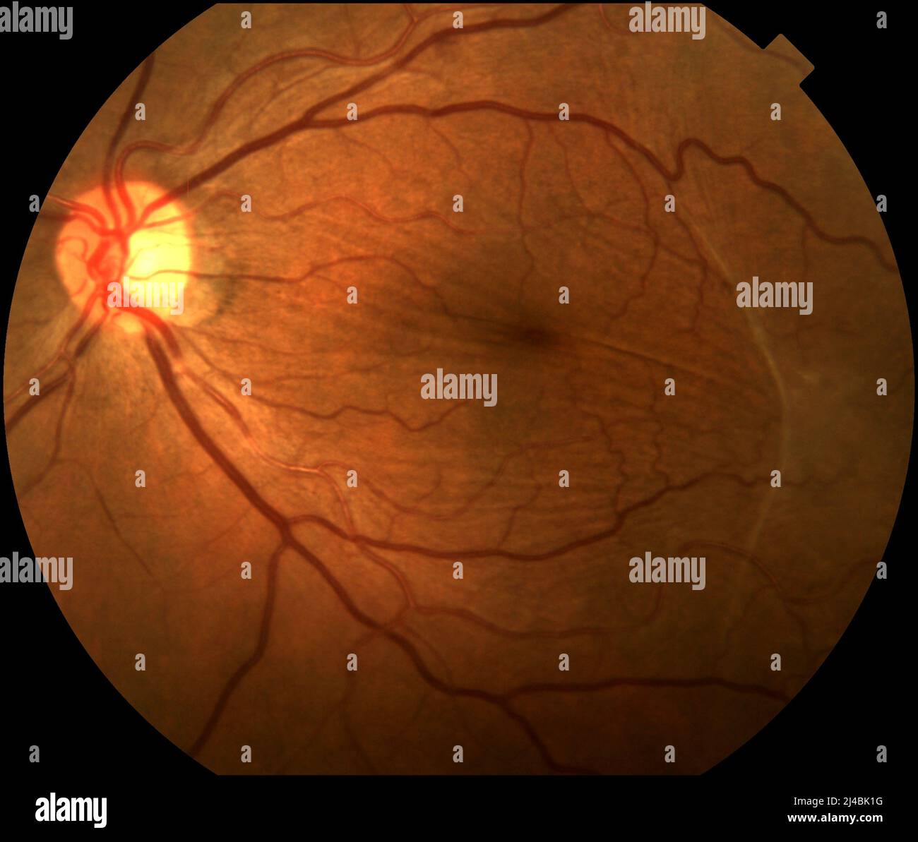 Temporal epiretinal membranes, fundoscopy Stock Photo - Alamy