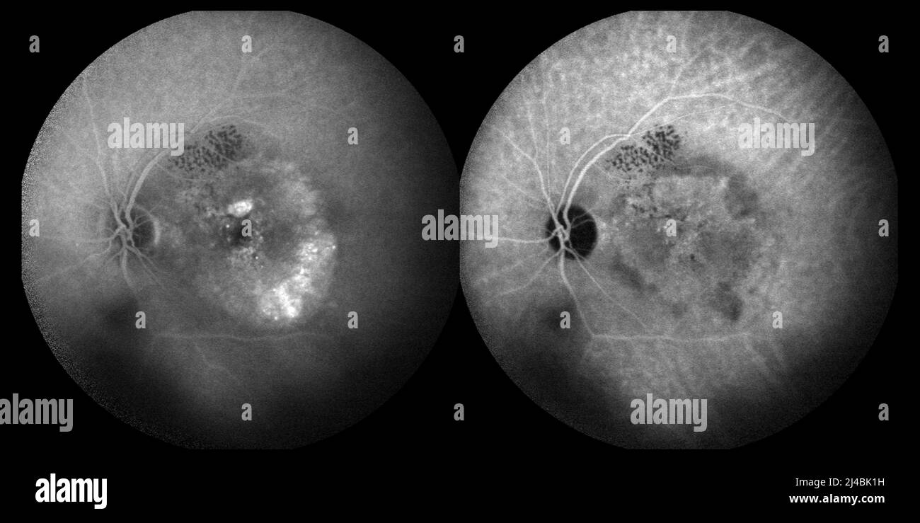 Macular degeneration, angiogram Stock Photo - Alamy