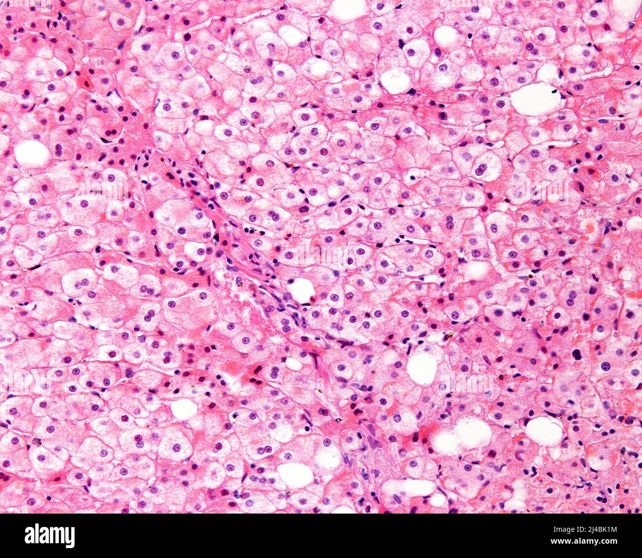 Fatty liver disease, light micrograph Stock Photo - Alamy