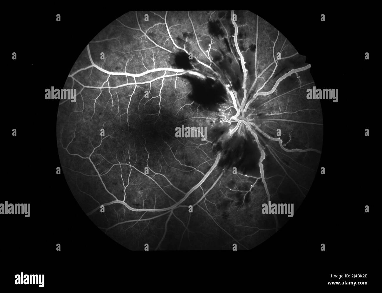 Anterior ischemic optic neuropathy, angiogram Stock Photo - Alamy