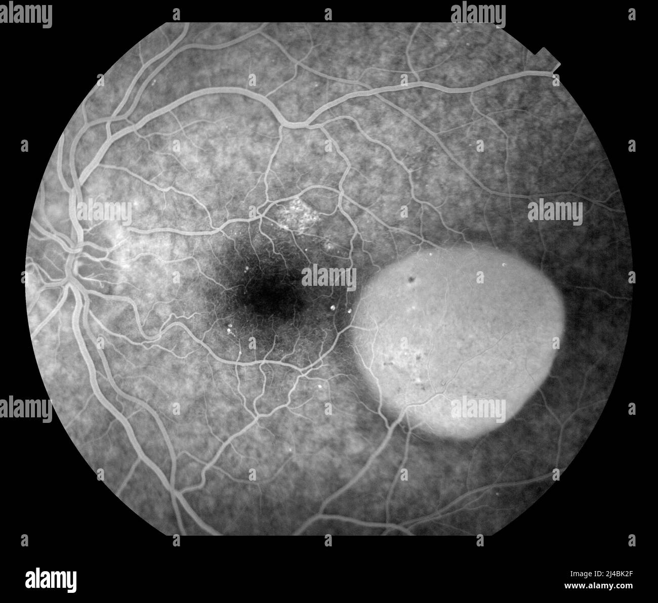 Eye damage due to diabetes, angiogram Stock Photo - Alamy