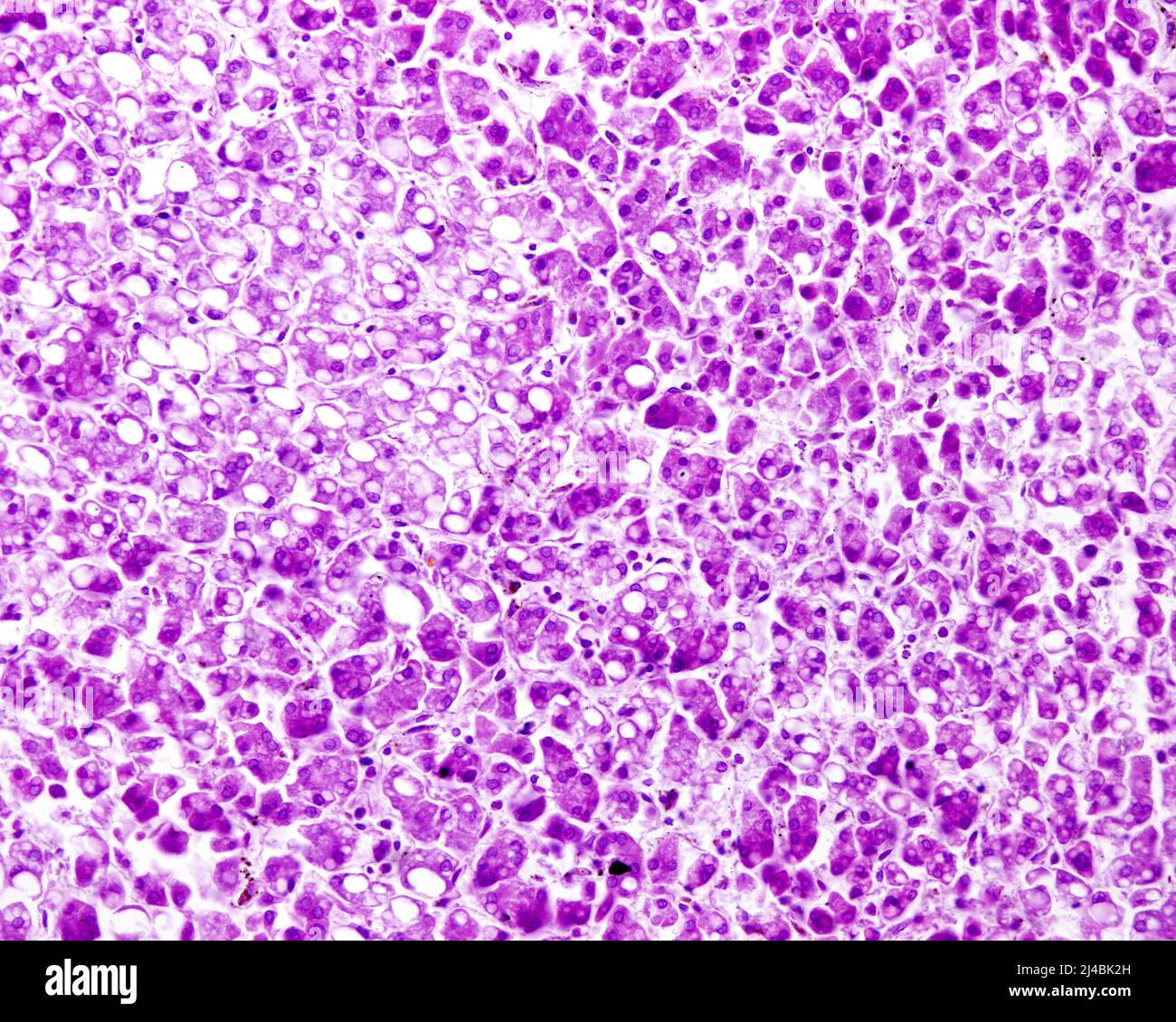 Fatty liver disease, light micrograph Stock Photo - Alamy