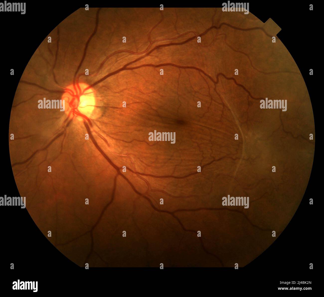 Temporal epiretinal membranes, fundoscopy Stock Photo - Alamy