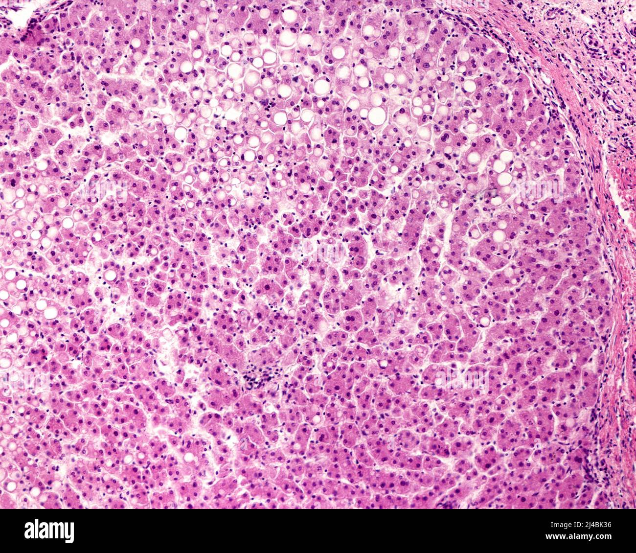 Cirrhosis, light micrograph Stock Photo - Alamy