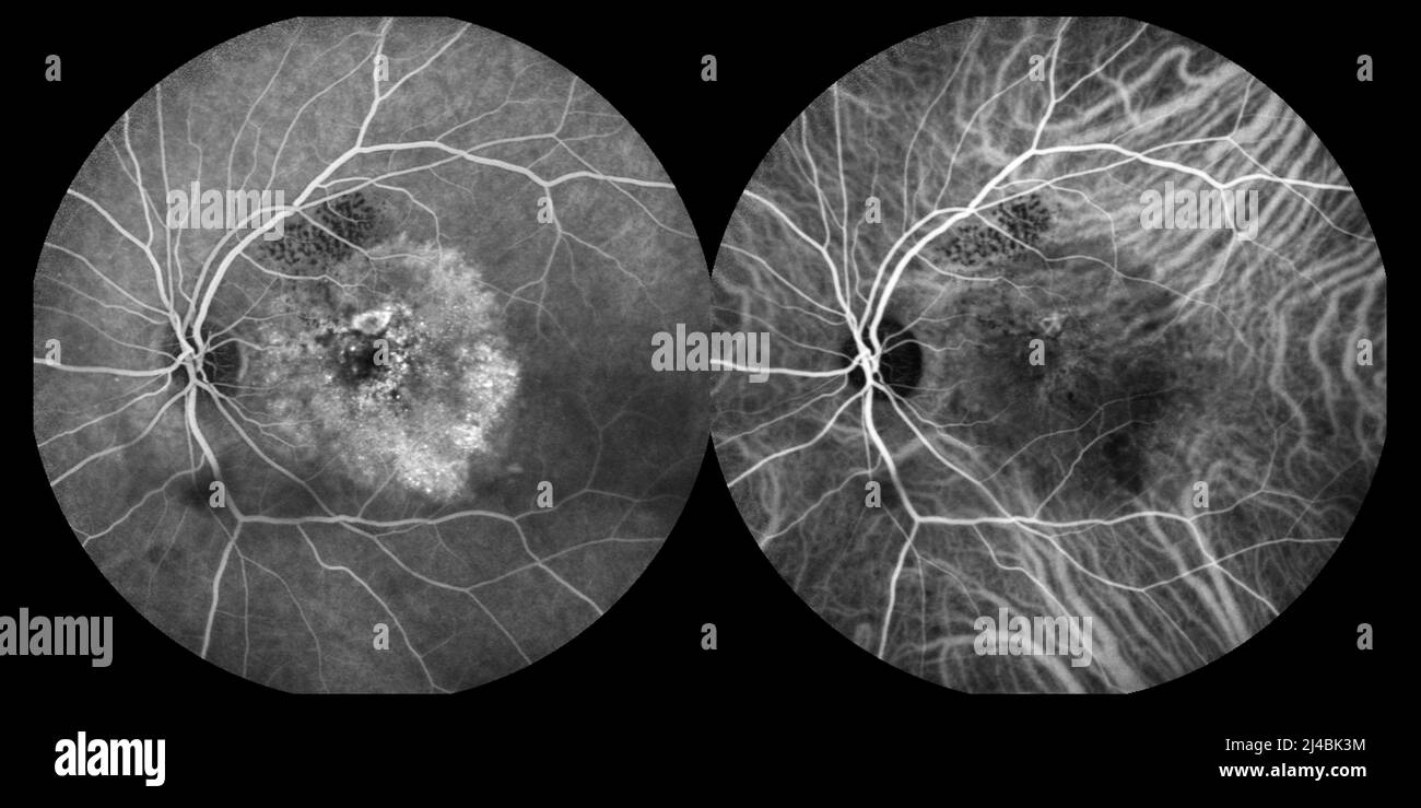 Macular degeneration, angiogram Stock Photo - Alamy