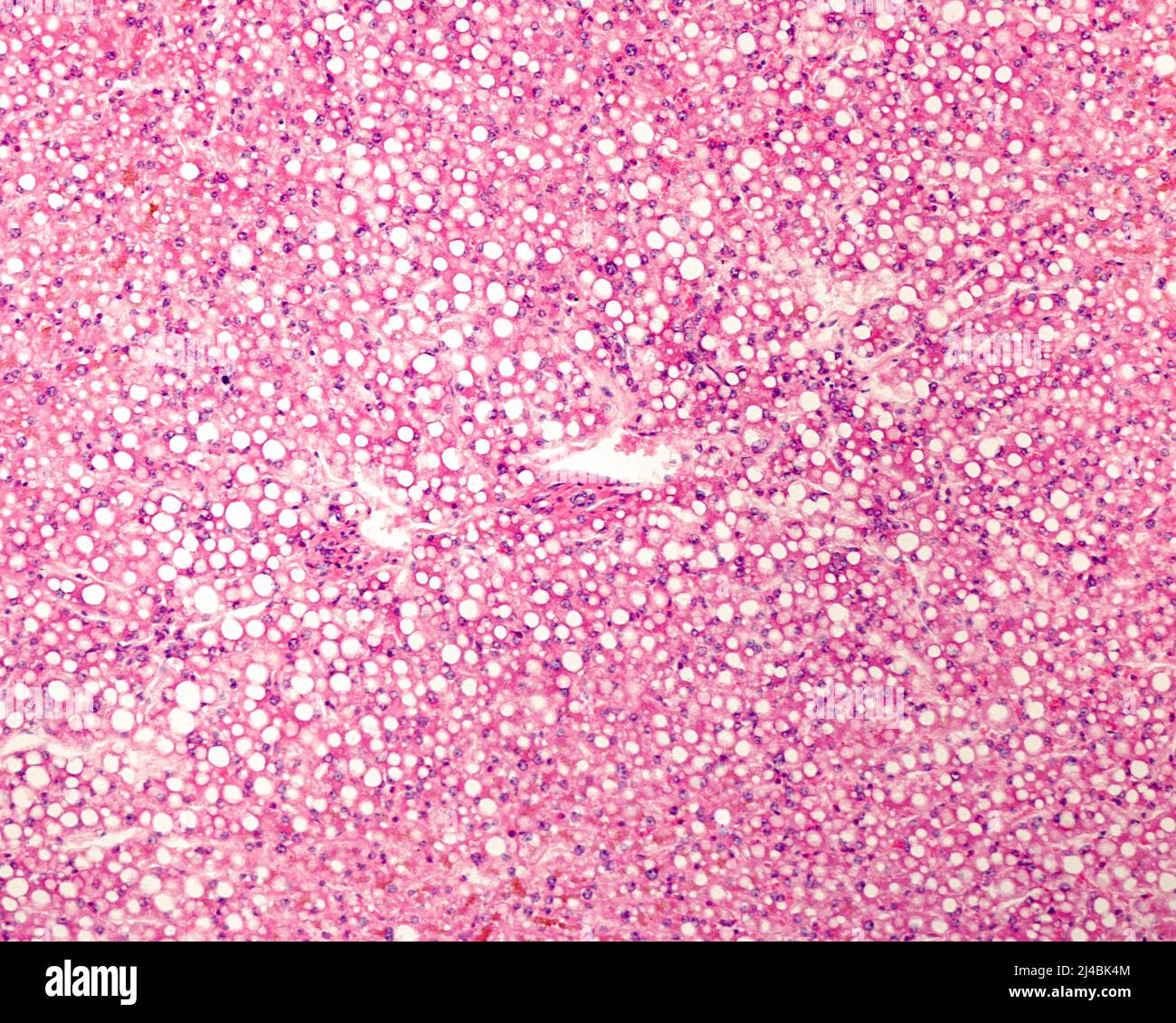 Fatty liver disease, light micrograph Stock Photo - Alamy