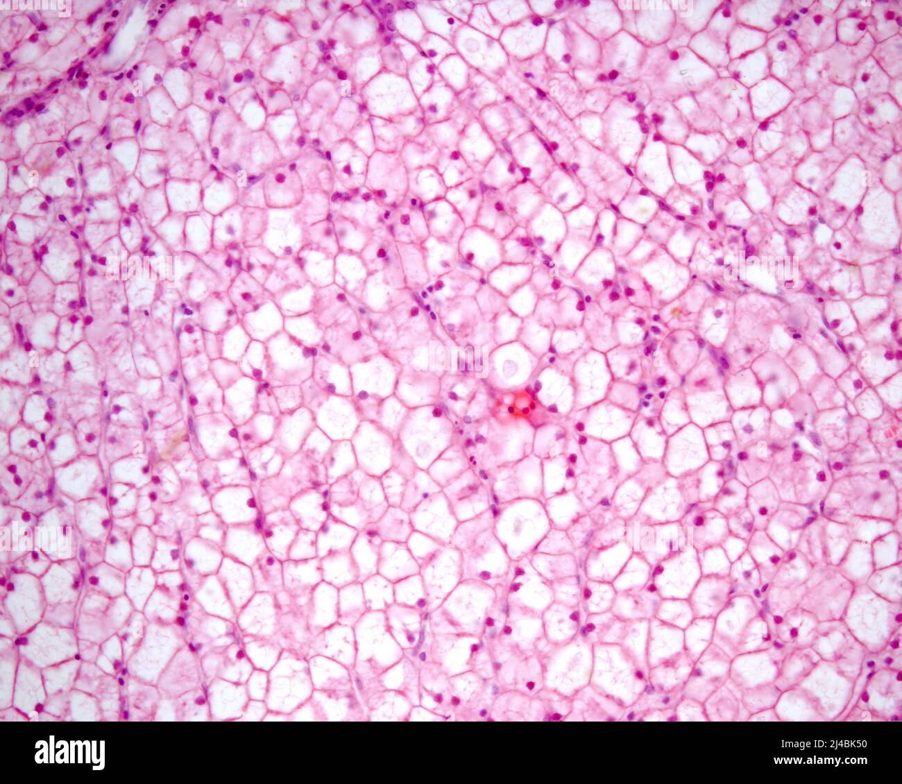 Glycogenosis, light micrograph Stock Photo - Alamy