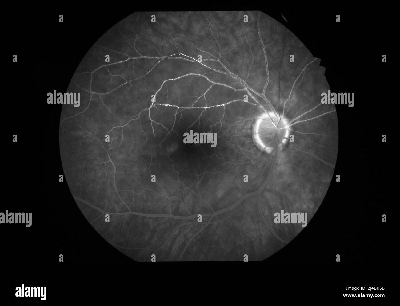 Hemispheric retinal artery occlusion, angiogram Stock Photo - Alamy