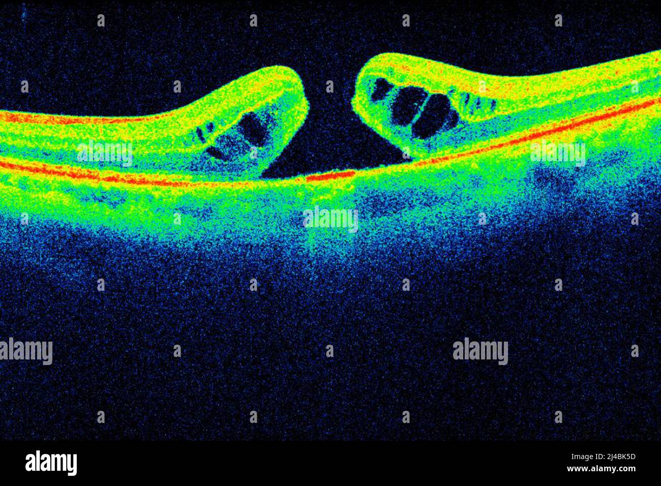 Macular hole, OCT scan Stock Photo - Alamy