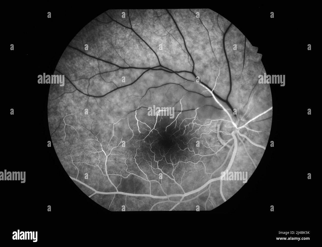 Hemispheric retinal artery occlusion, angiogram Stock Photo - Alamy