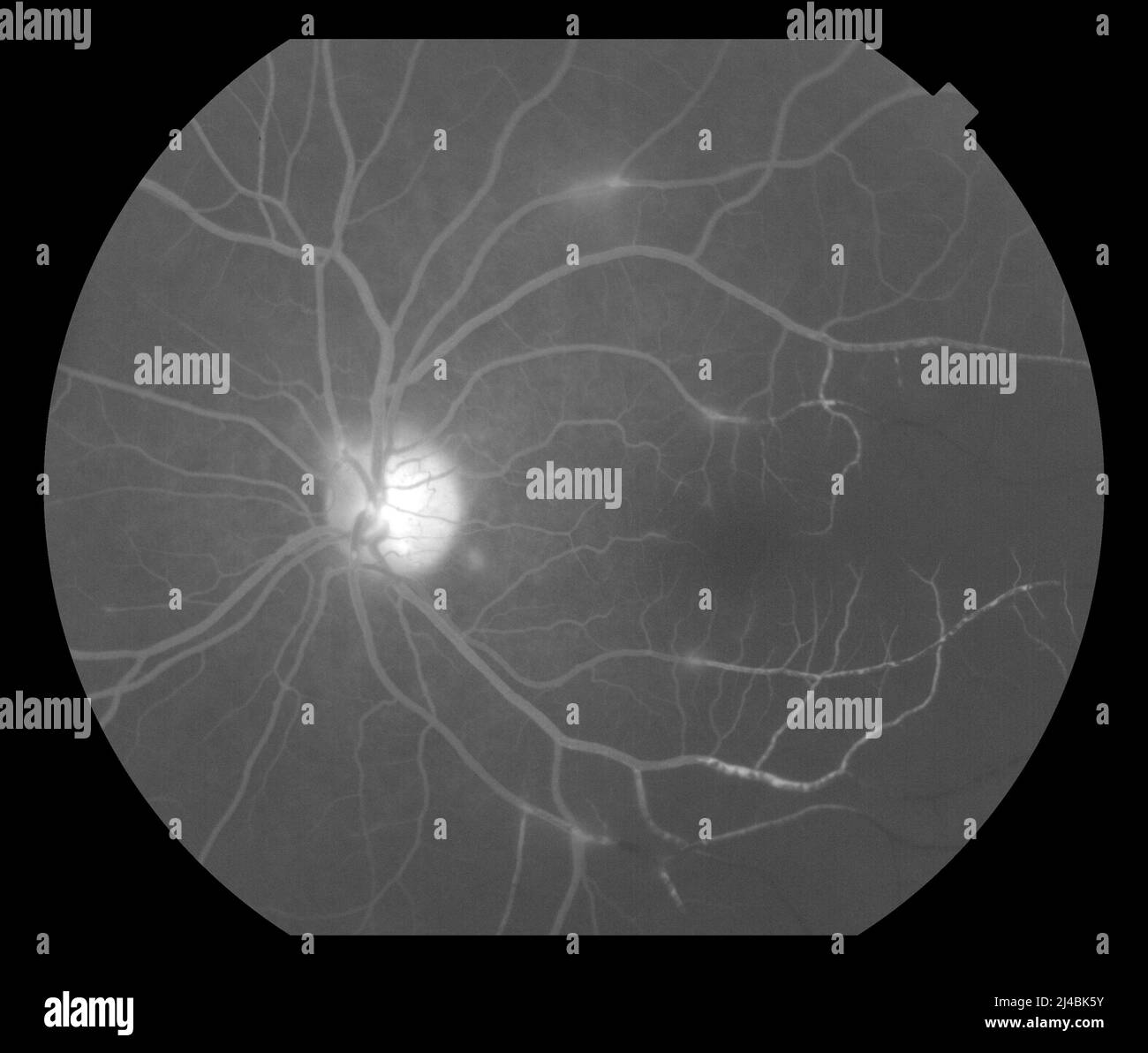 Hemispheric retinal artery occlusion, angiogram Stock Photo - Alamy
