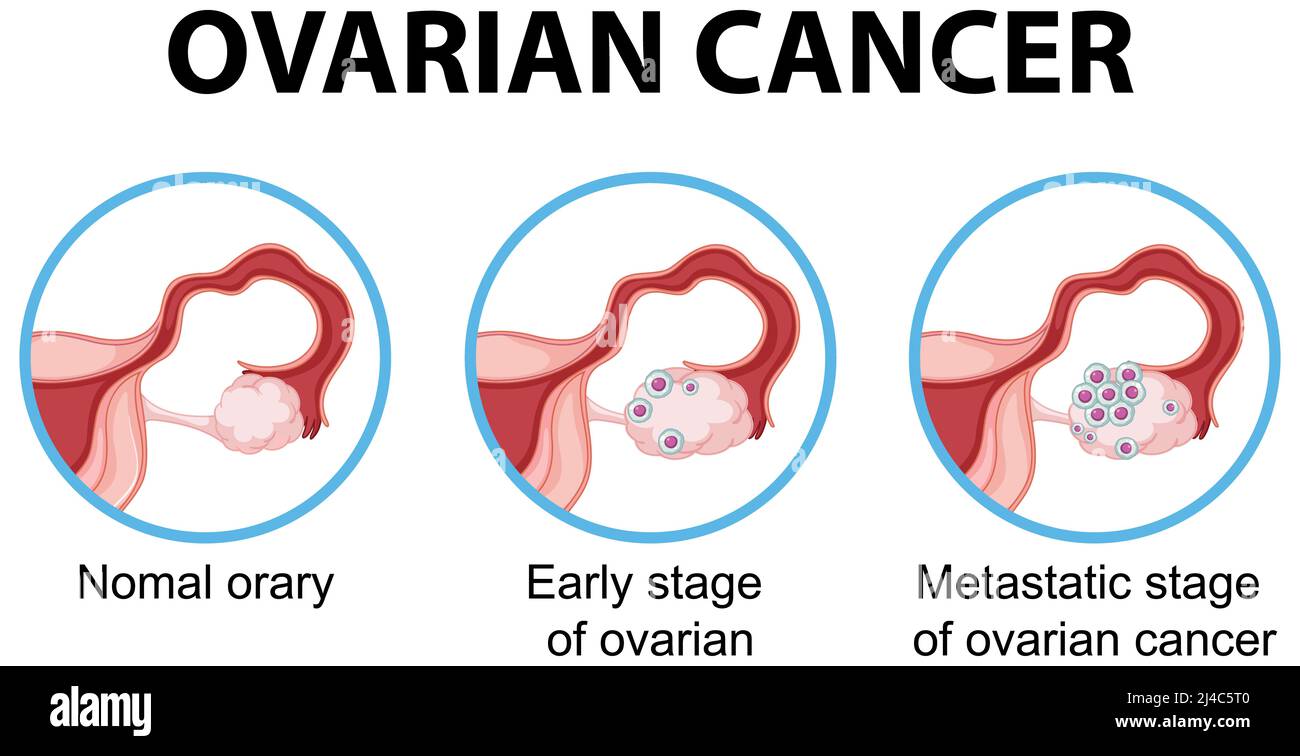 Diagram showing ovarina cancer in human illustration Stock Photo - Alamy