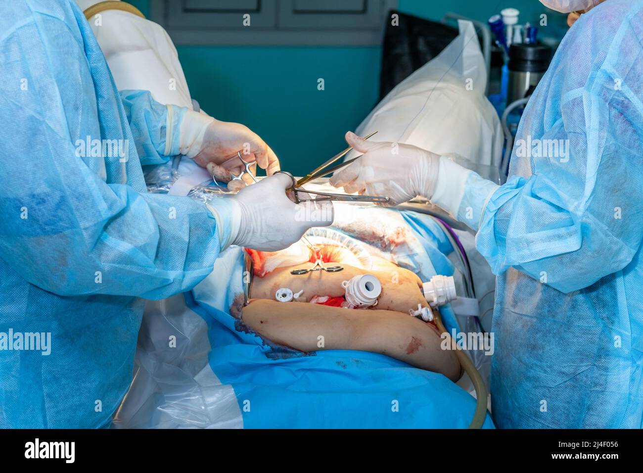 Abdominal laparoscopy in operating room hi-res stock photography and ...