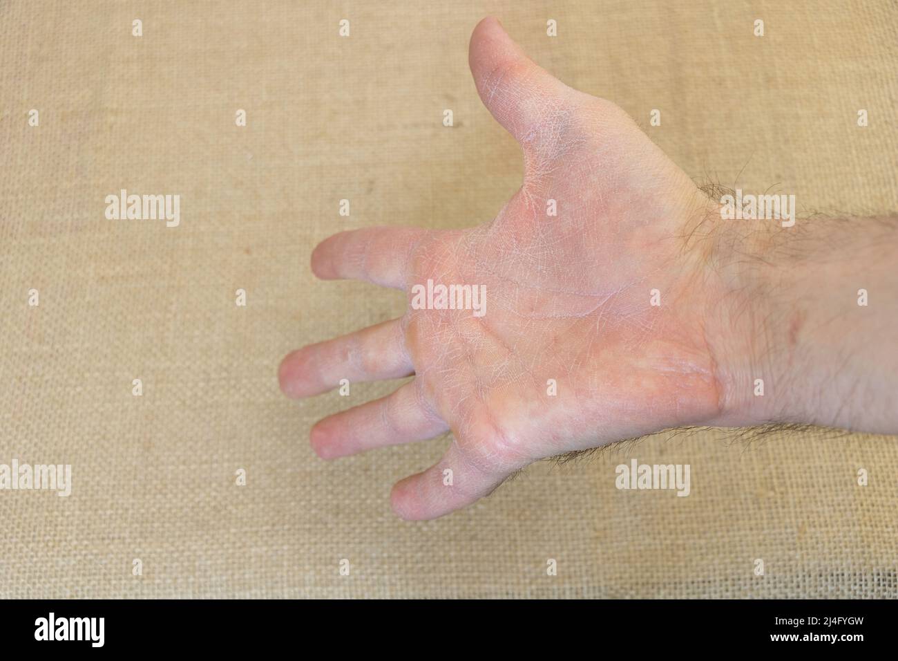 A man's hand dehydrated with cracks due to the cold wind of early ...