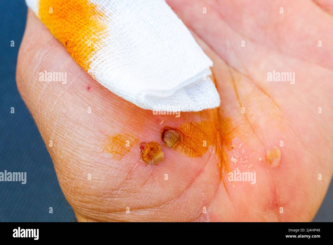 Blister on palm of hand hi-res stock photography and images - Alamy