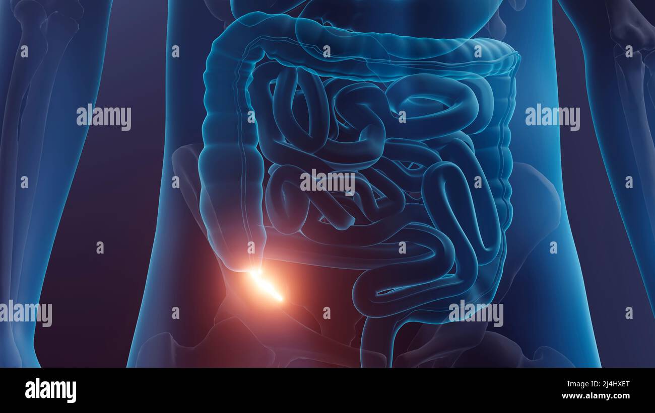 Appendicitis, conceptual illustration Stock Photo - Alamy